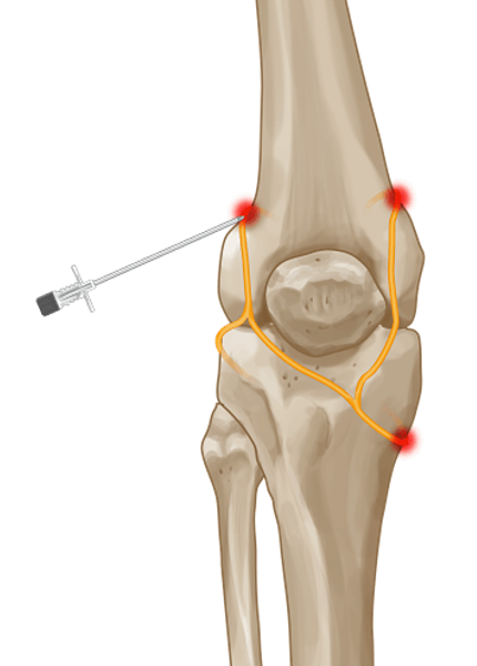 Genicular Nerve Block And Radiofrequency Ablation Gnrfa Appalachian Orthopedics